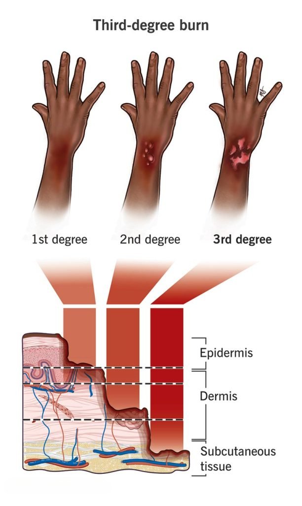 Burn treament – Doctor Furqan Zahir